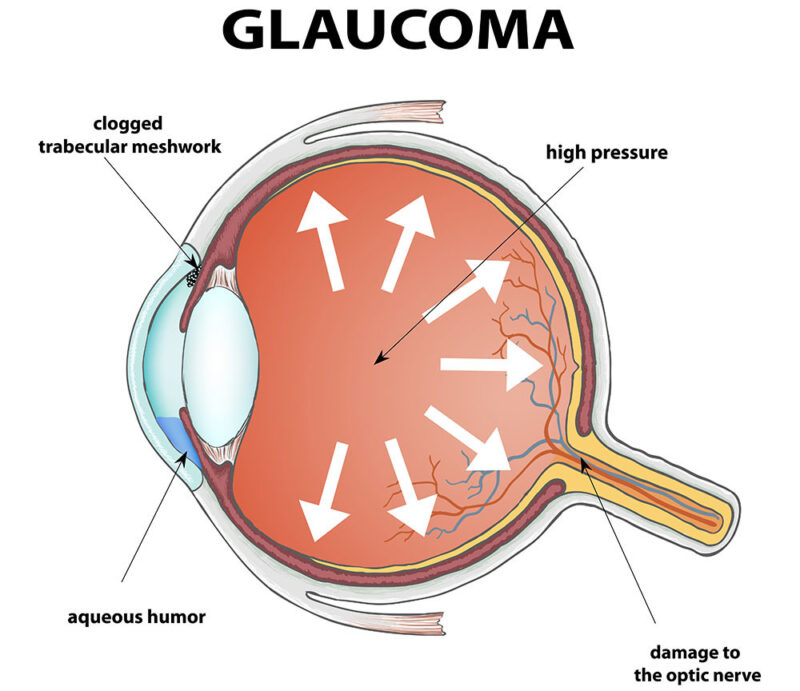 Glaucoma Prevention: Simple Steps to Take Control - New Jersey Eye Center